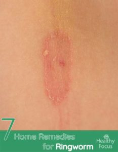 7 Home Remedies for Ringworm - Healthy Focus