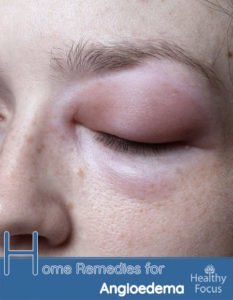 Home Remedies for Angioedema - Healthy Focus